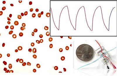 Video: Microfluidic sensor designed to monitor sickle cell disease ...