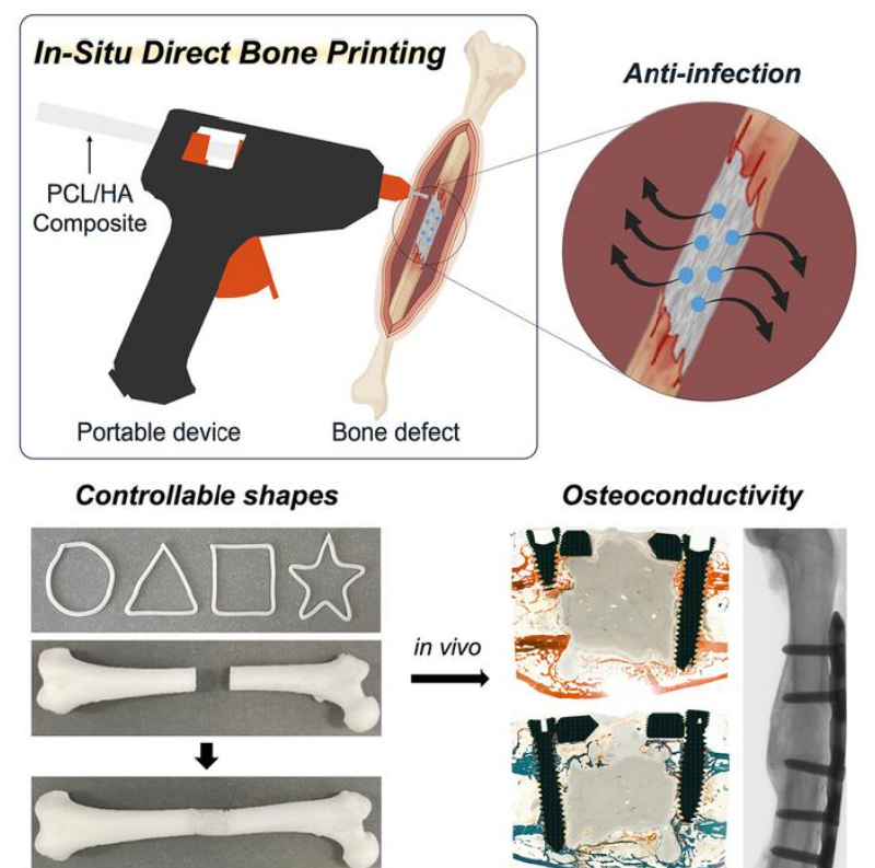 "Bone-gun" can generate bone grafts directly onto fractures in animals ...