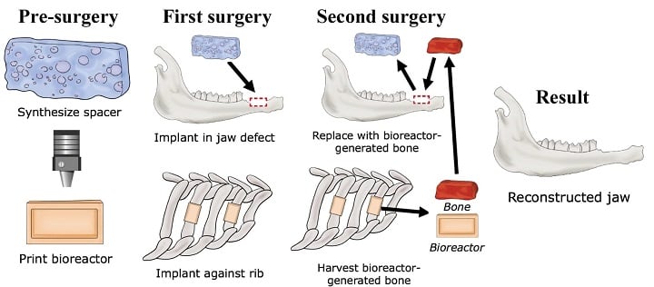 Rib-attached bioreactor grows bone for jaw repair | GlobalSpec