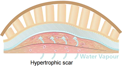 Smart Pad Puts Pressure on Scars | GlobalSpec